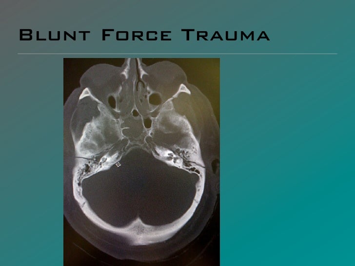 FCA 0111 - Blunt Force Trauma