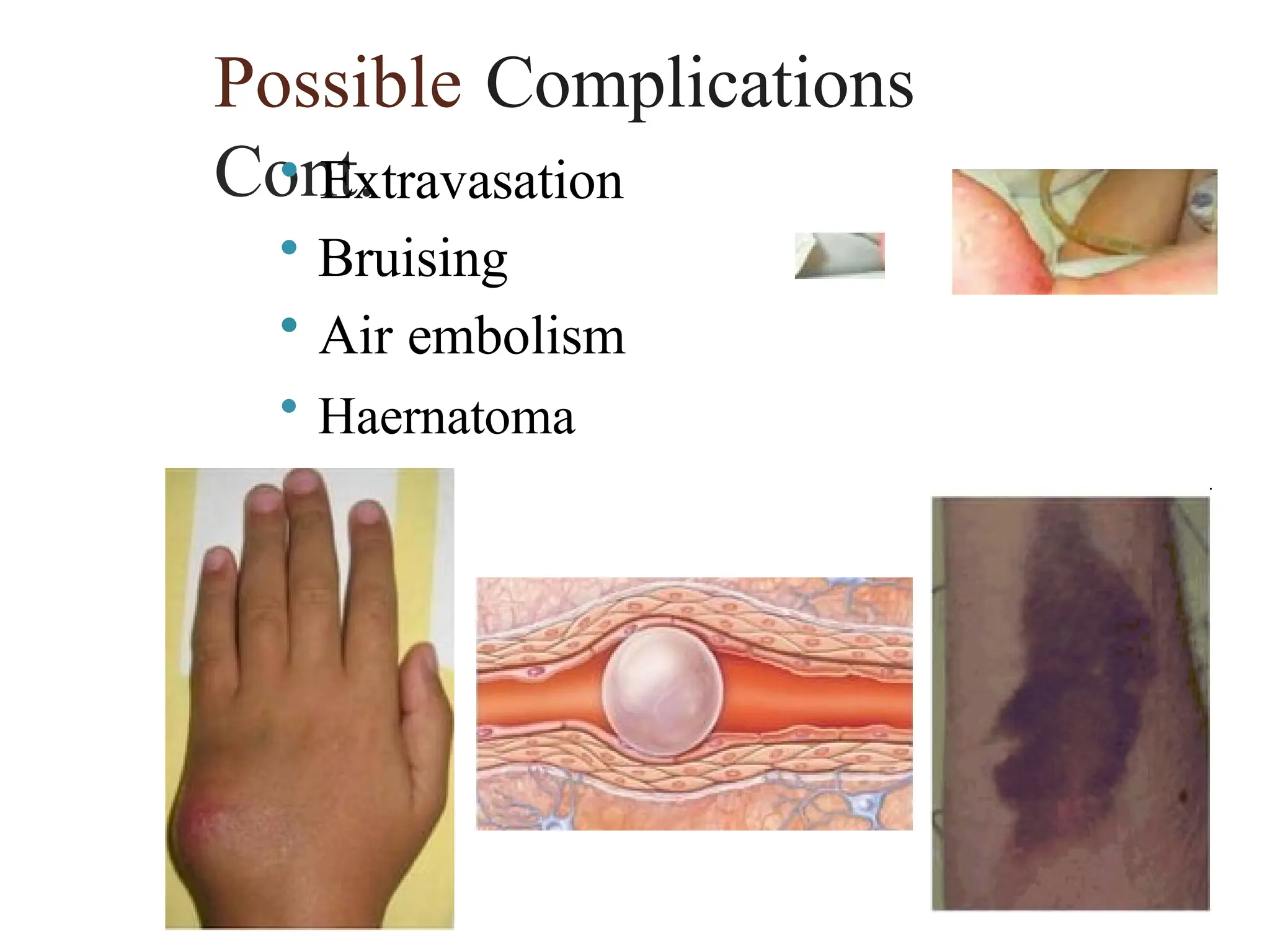 IV Cannulation and techniques and complications.pptx