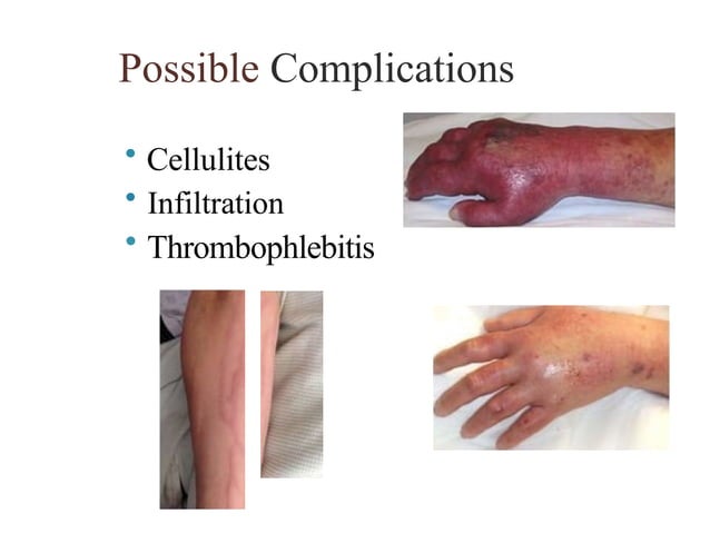 IV Cannulation and techniques and complications.pptx