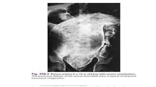 Functional constipation and encopresis in children | PPTX