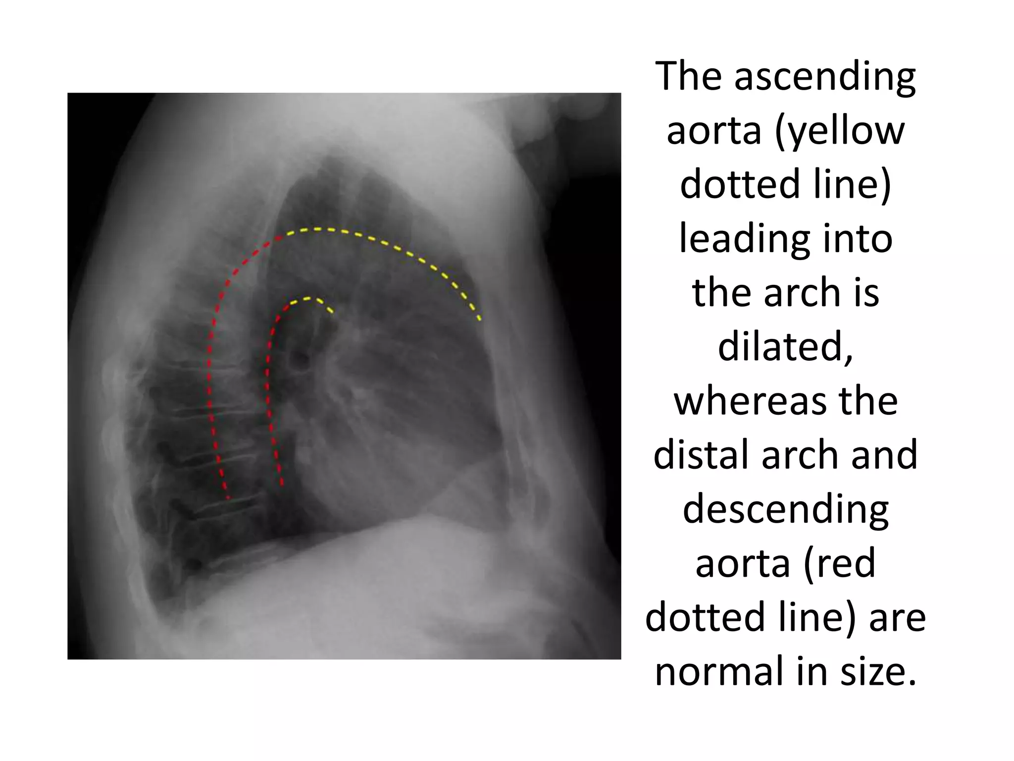 AORTIC STENOSIS | PPTX | Heart and Cardiovascular Diseases | Diseases ...