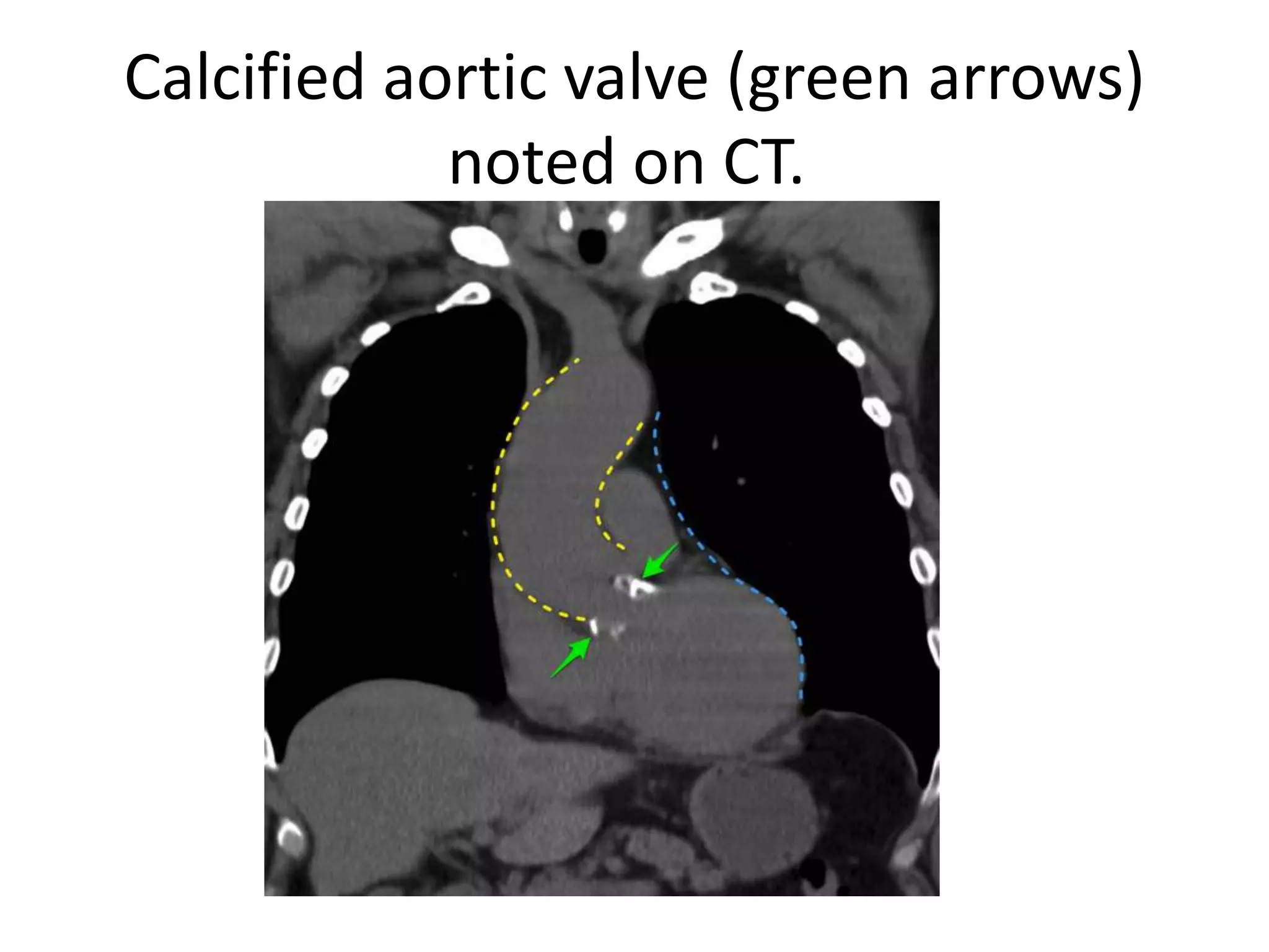 AORTIC STENOSIS | PPTX