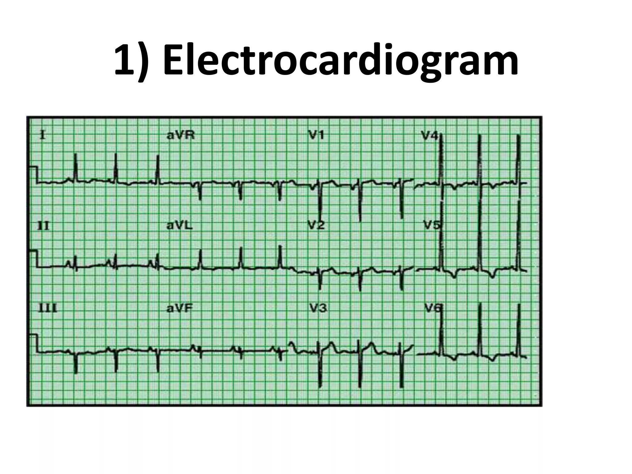 AORTIC STENOSIS