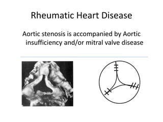 AORTIC STENOSIS | PPTX