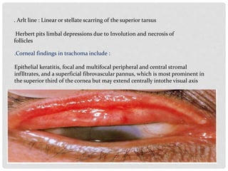Bacterial_ocular_infections.pptx