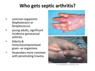 Septic Arthritis Finger