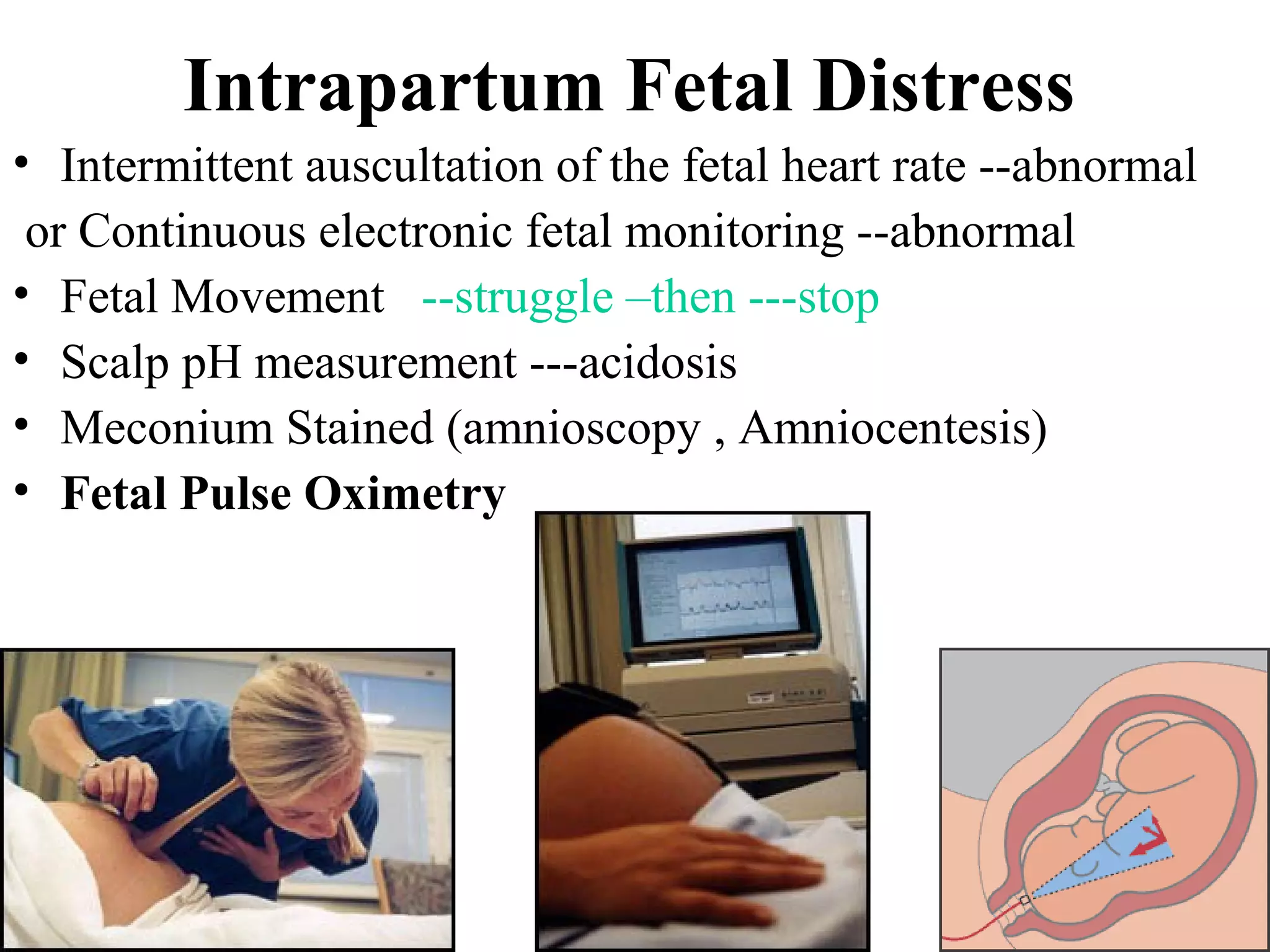 Fetal distress | PPS