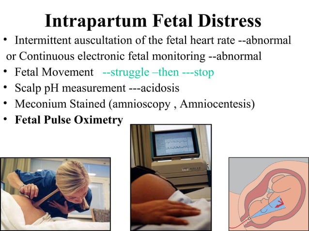 Fetal distress | PPS | Pregnancy | Reproductive Health