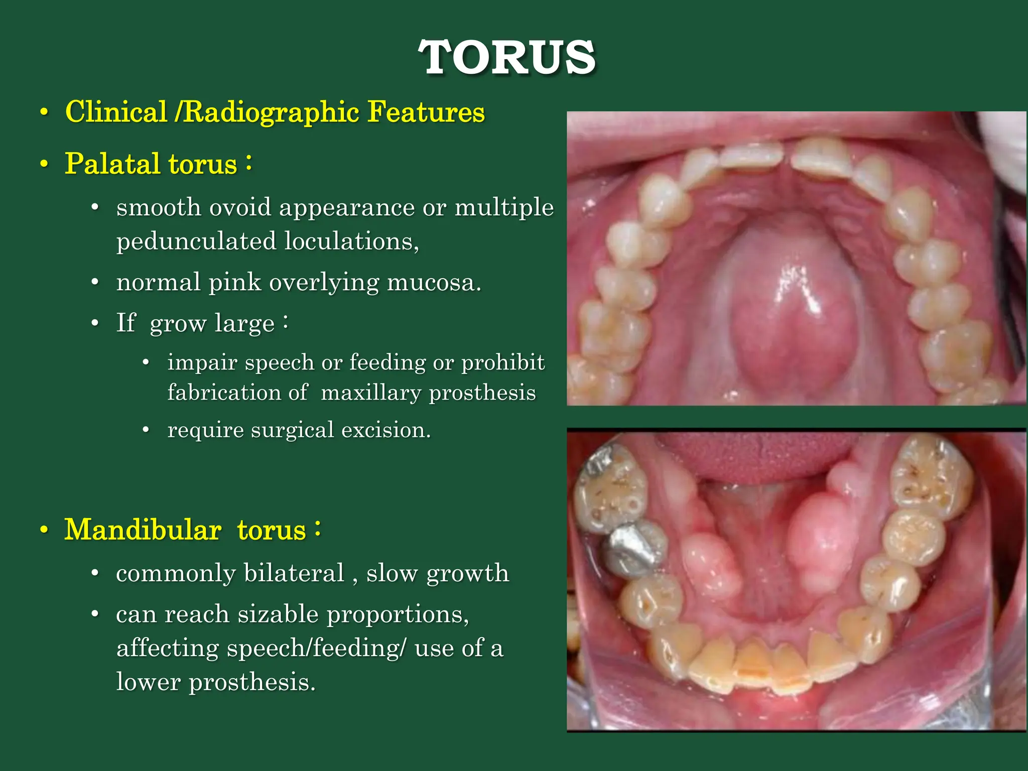 swelling_of_jaw_and_surgery_of_mandible_my_ppt.pptx | Dental Health ...