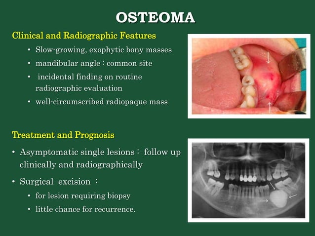swelling_of_jaw_and_surgery_of_mandible_my_ppt.pptx | Dental Health ...