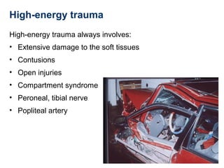 Tibial plateau | PPT