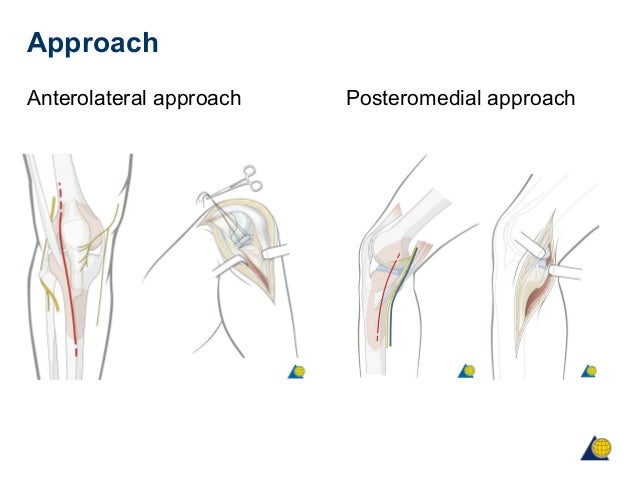 Tibial plateau