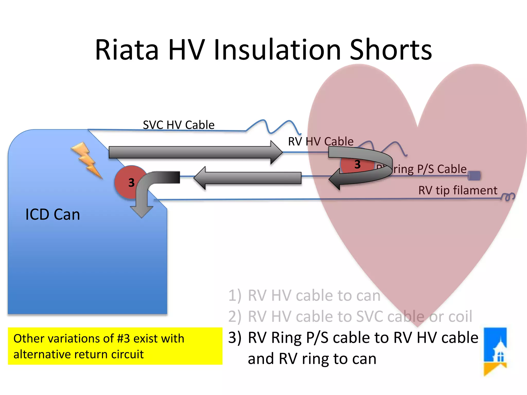 ICD System High Voltage Component Failure (Presented to FDA) | PPTX