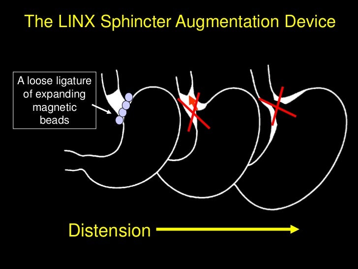 FDA Advisory Panel Linx Presentation 011112