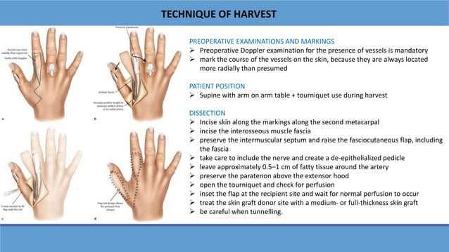 FDMA FLAP - The first dorsal metacarpal artery (FDMA) flap is used ...