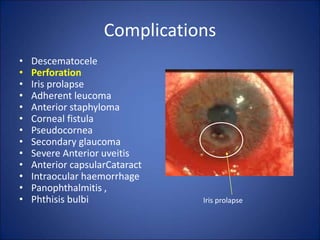RAMJI PANDEY cornea class-2 | PPT
