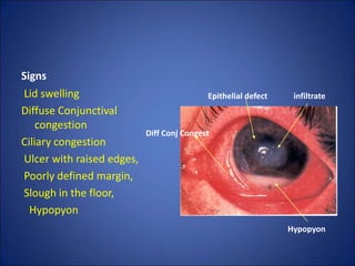RAMJI PANDEY cornea class-2 | PPT