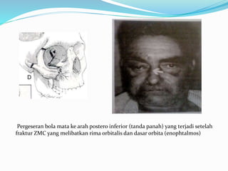 fdokumen.com_fraktur-zygomaticomaxillary-complex-55c60d5e34e1b.pptx