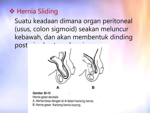 fdokumen.com_hernia-570cbaec68745.ppt