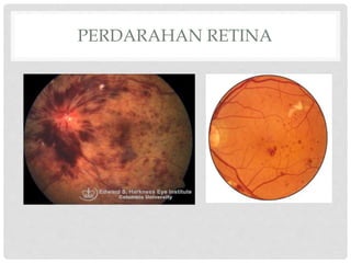fdokumen.com_retinopati-diabetik-dan-hipertensi-sukoi.pptx