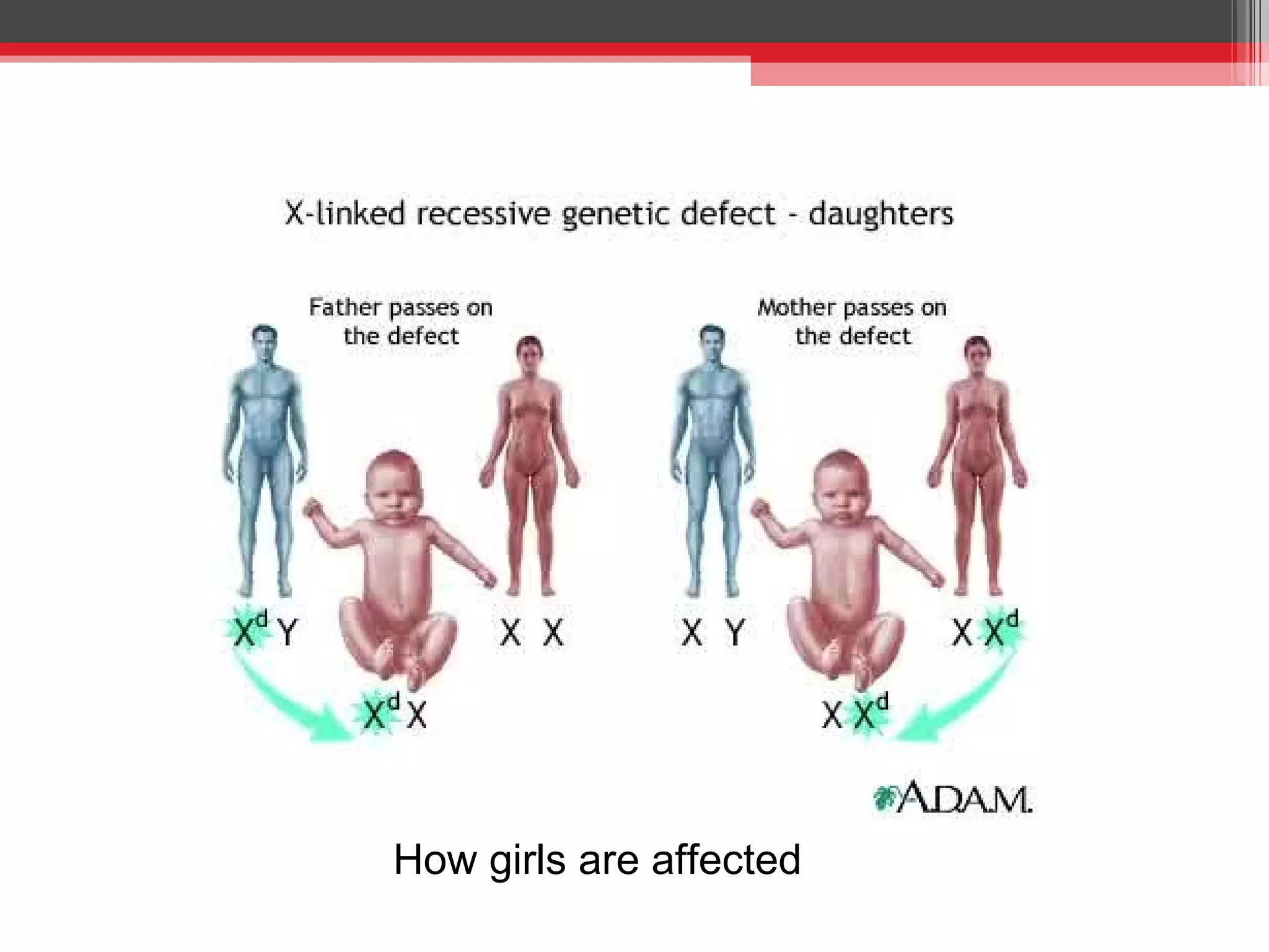 Duchenne Muscular Dystrophy | PPT