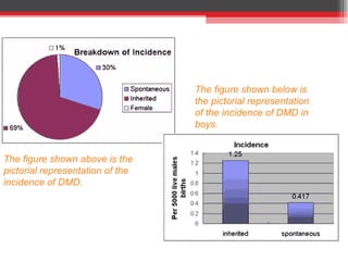 Duchenne Muscular Dystrophy | PPT