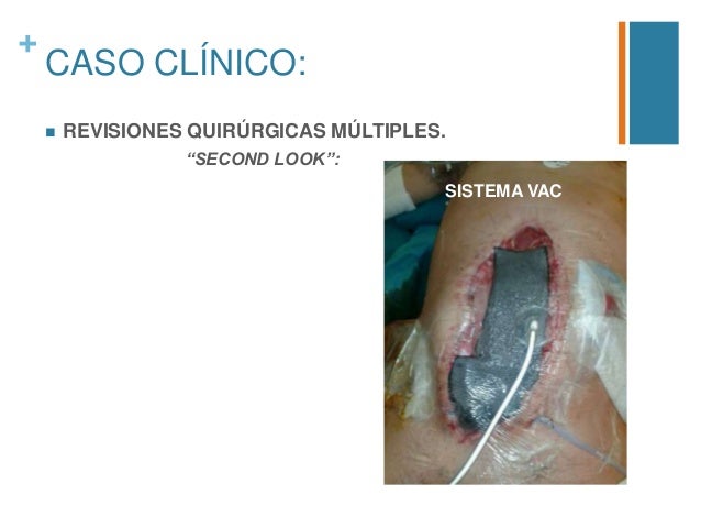 Caso clínico: Nutrición enteral en fístula enteroatmosférica de alto