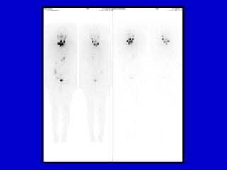 Fear of stunning: I-123 vs 131 for whole body imaging in thyroid cancer ...