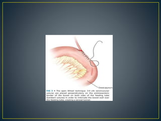 Feeding jejunostomy | PPTX