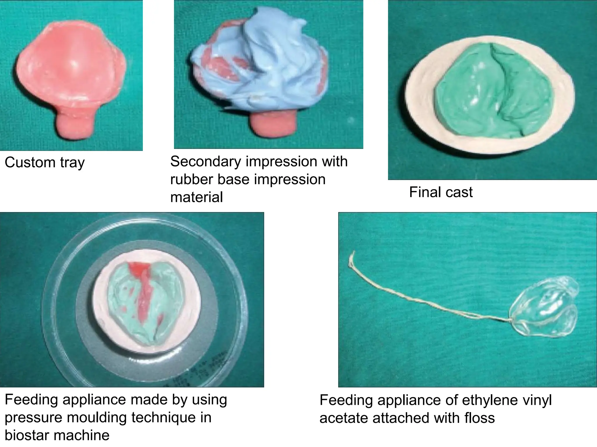 Feeding plate for a newborn with Cleft Palate.pptx