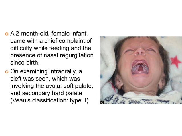 Feeding plate for a newborn with Cleft Palate.pptx