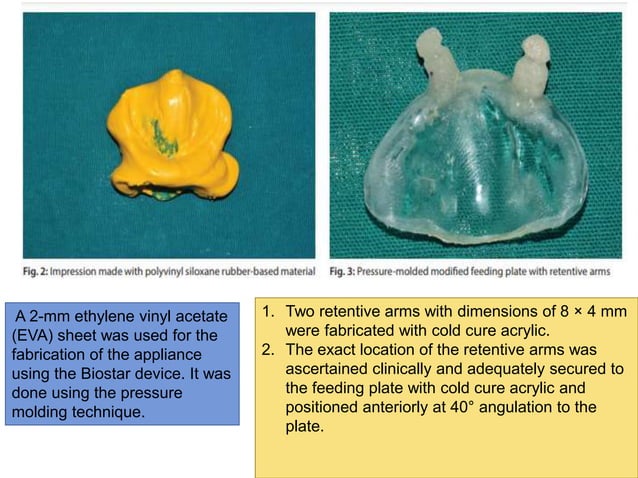 Feeding plate for a newborn with Cleft Palate.pptx