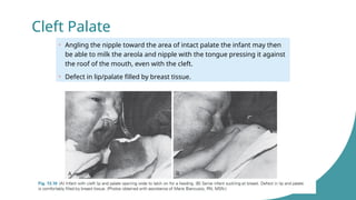 Feeding in Cleft lip,cleft palate and cranio facial abnormalities | PPTX