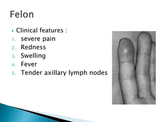 How Do You Treat Finger Felons