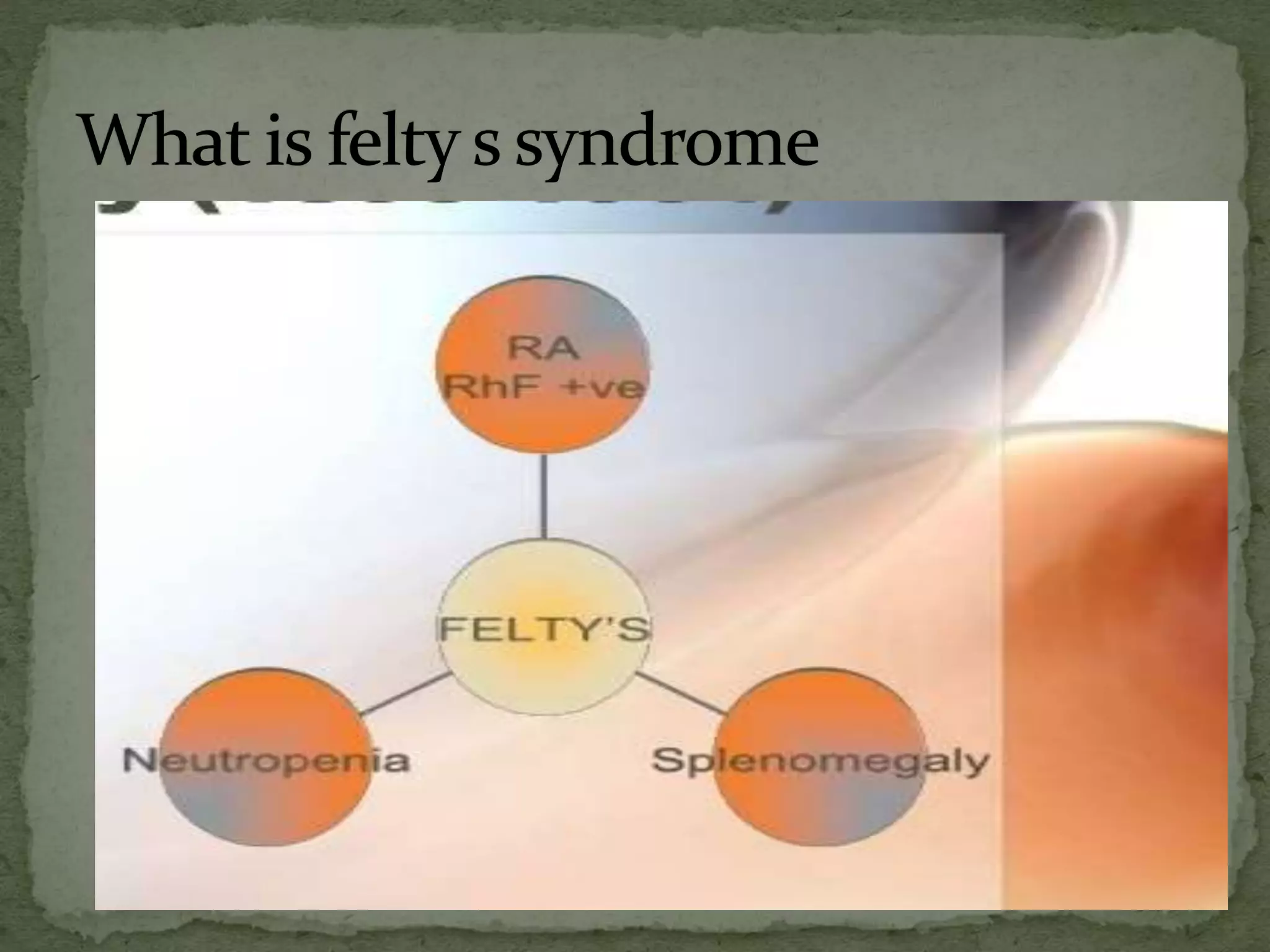 Feltys syndrome | PPTX