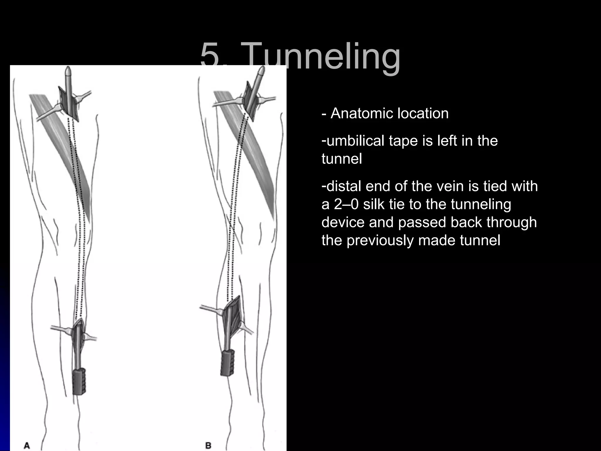 Fem distal bypass | PPT