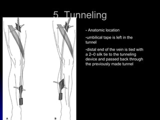 Fem distal bypass | PPT