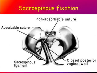 FEMALE PELVIC APPLIED ANATOMY BY DR SHASHWAT JANI | PPT
