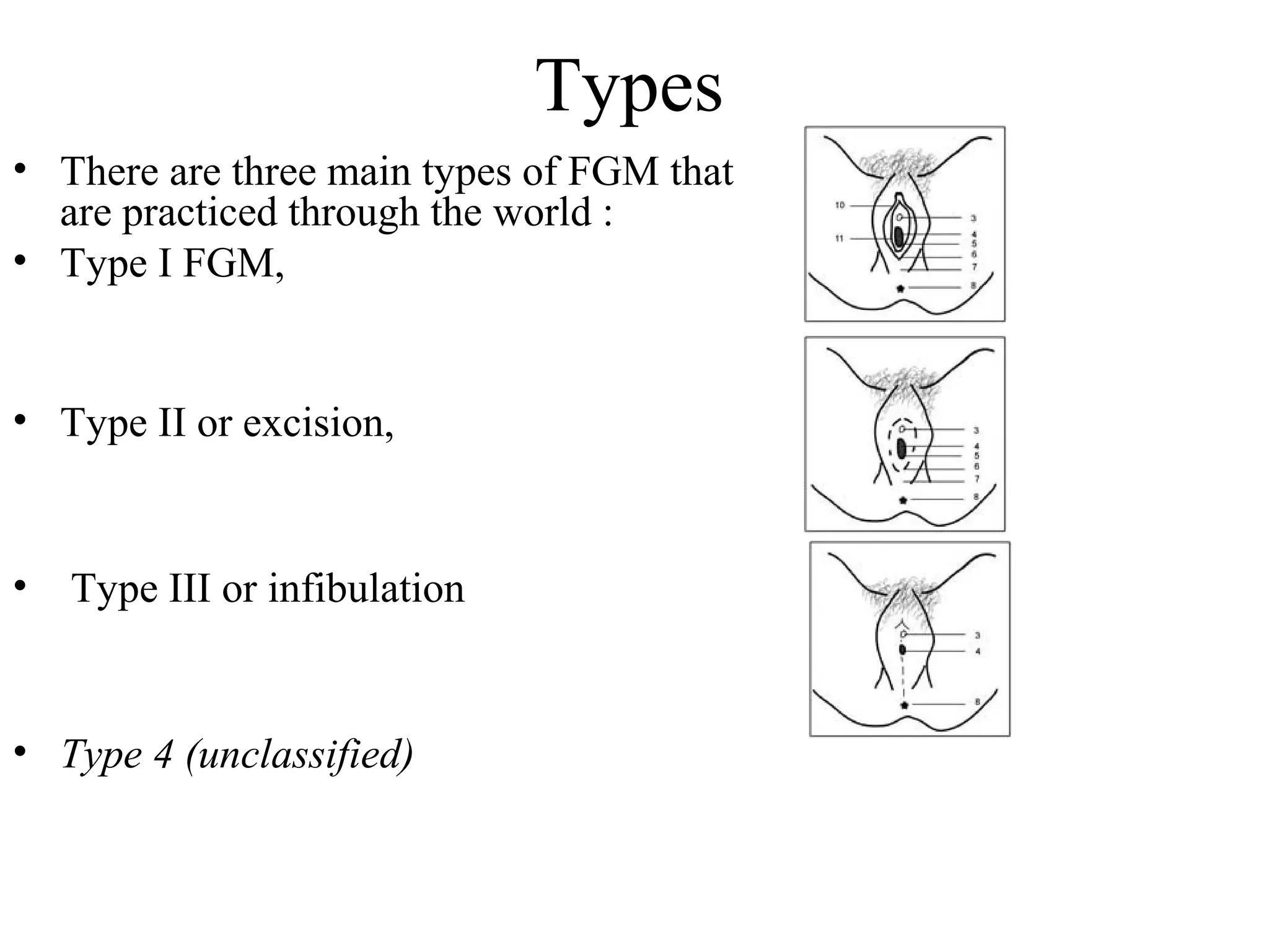 Types Of Female Circumcision