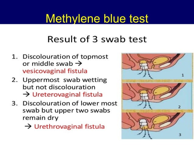 Female genital fistula | PPT | Digestive Disorders | Diseases and ...