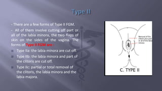 Female genital mutilations type and complications | PPTX