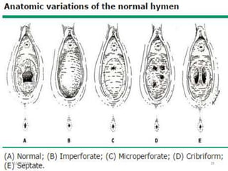 Cribriform Hymen