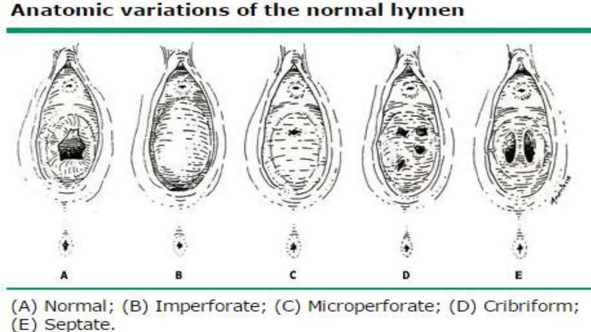 Female genital tract(Congenital malformation).pptx