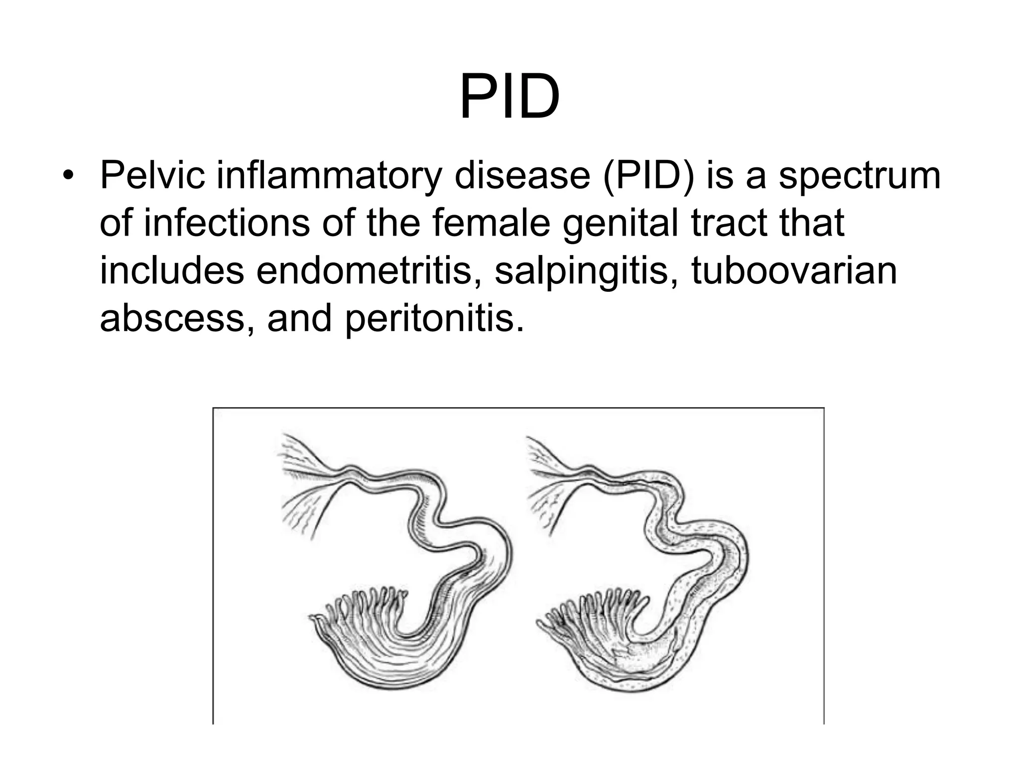 Female infertility | PPTX