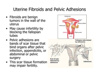 Female infertility | PPTX