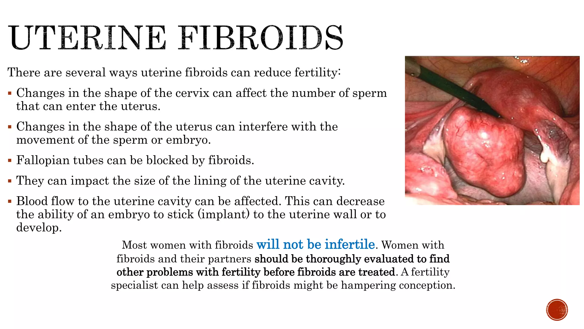 FEMALE INFERTILITY | PPTX