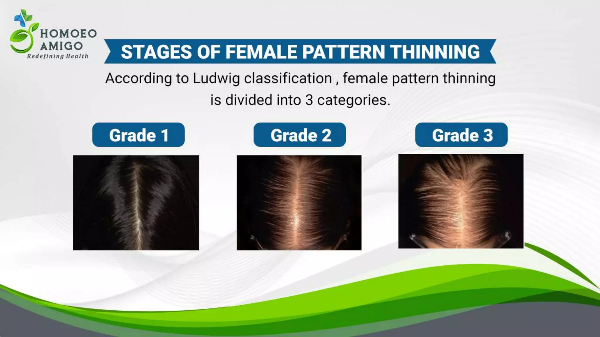 Female pattern hair thinning_ Homoeo Amigo | PPTX