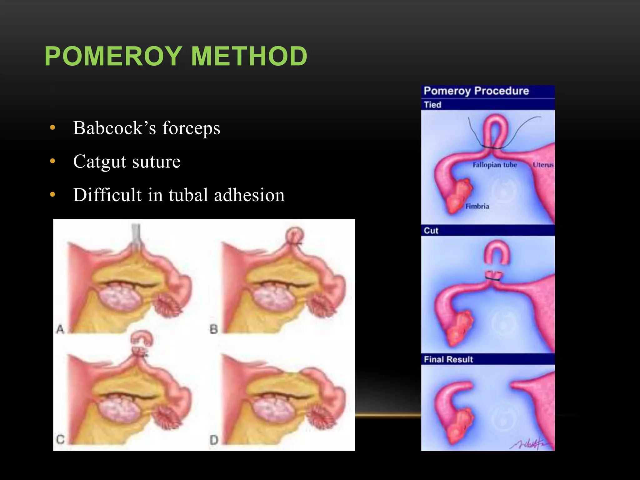 Female sterilisation | PPTX