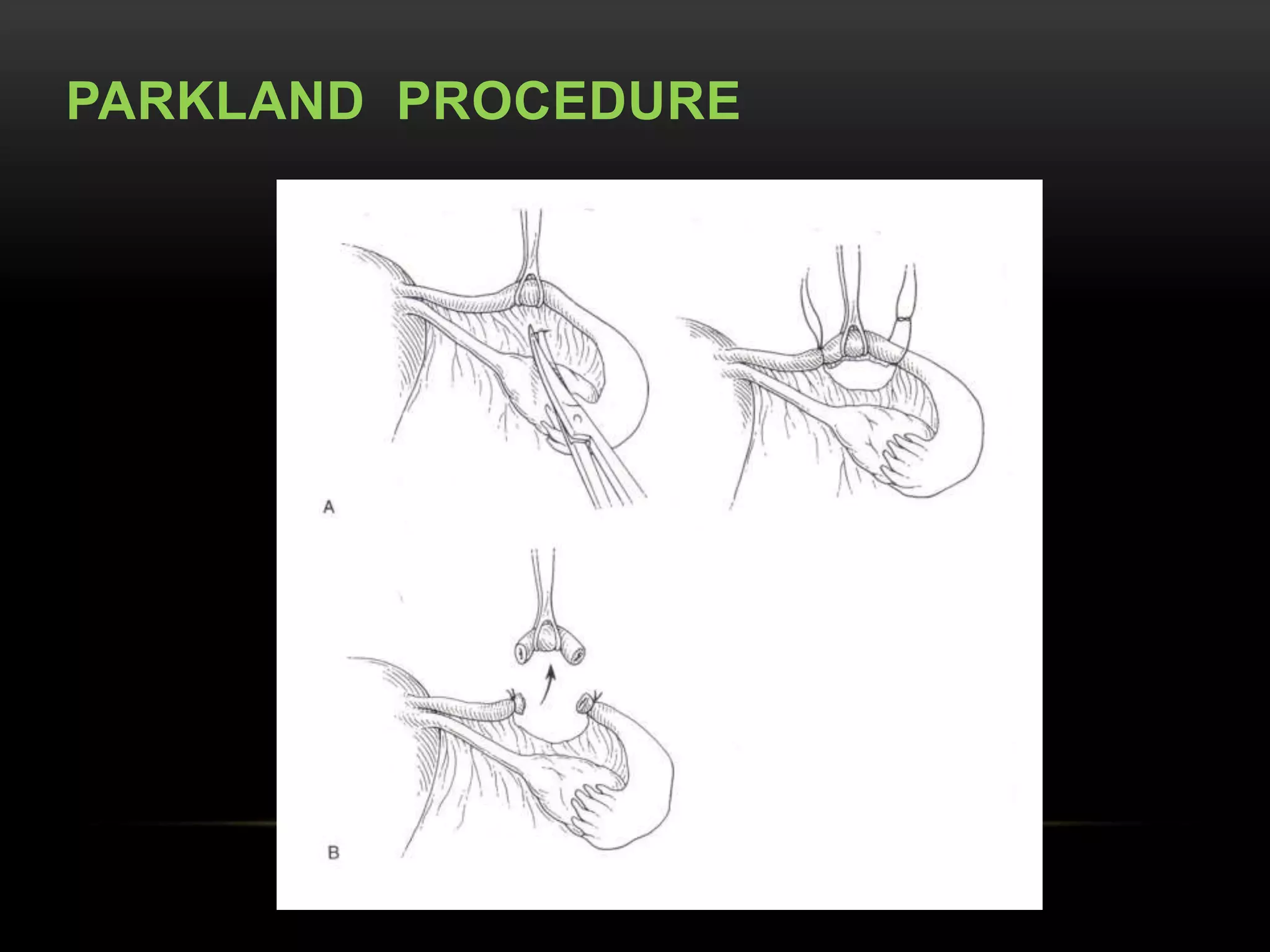 Female sterilisation | PPTX