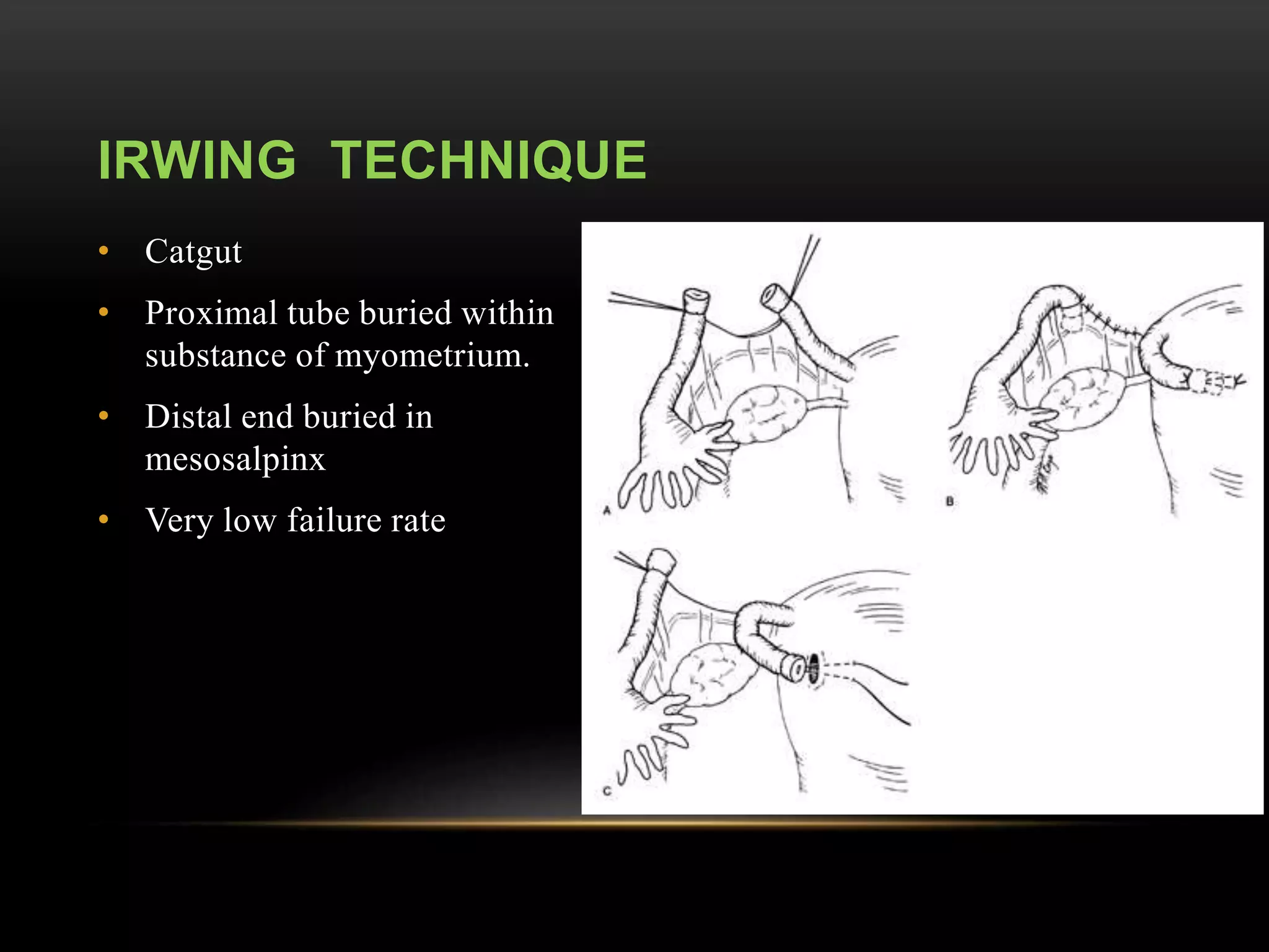 Female sterilisation | PPTX